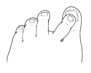 CROSSOVER TOES - Infinity Foot & Ankle | Dr. Parul K. Patel, DPM